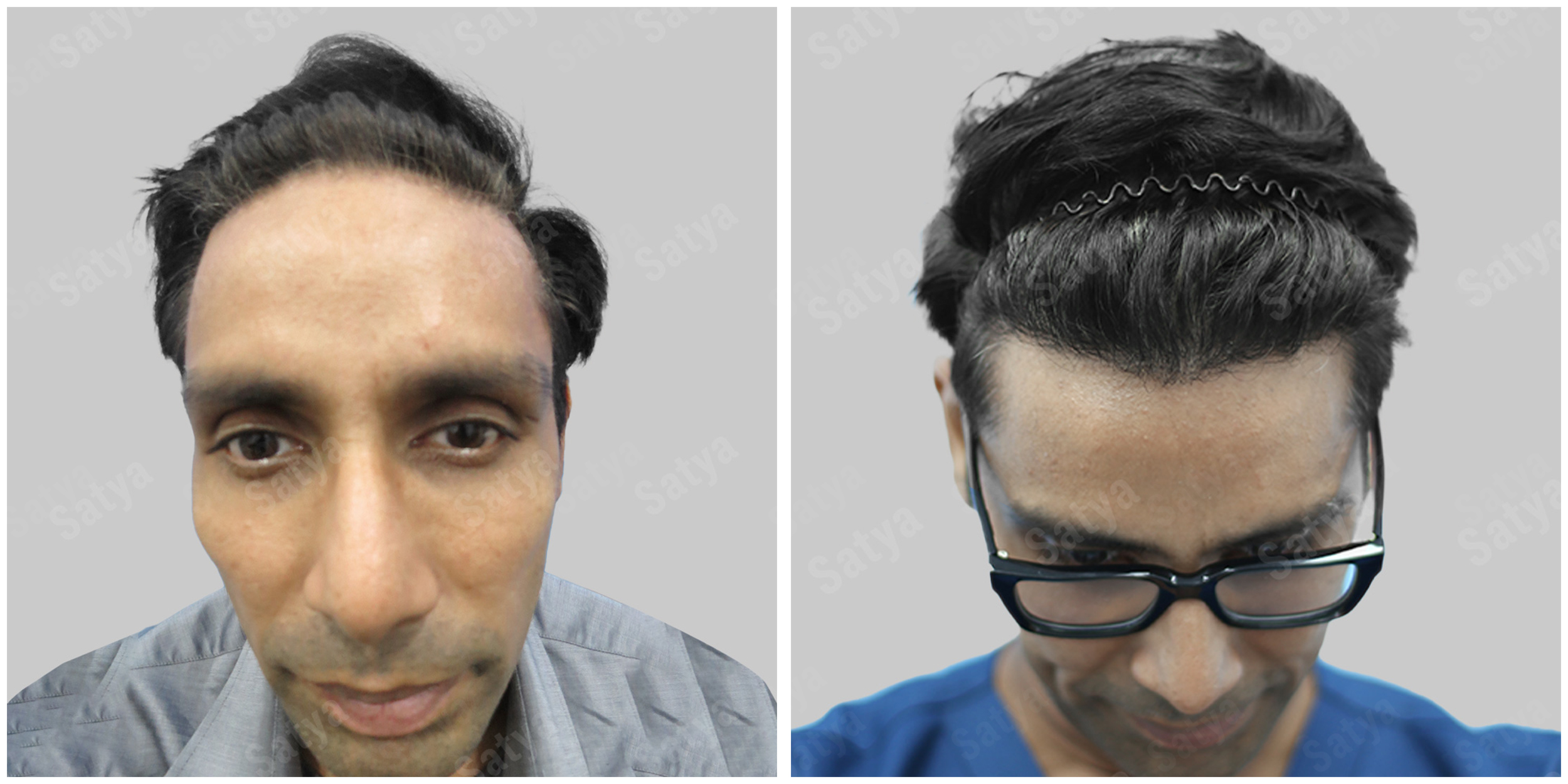 Best Hair transplant in India | Satya Hair Solutions
