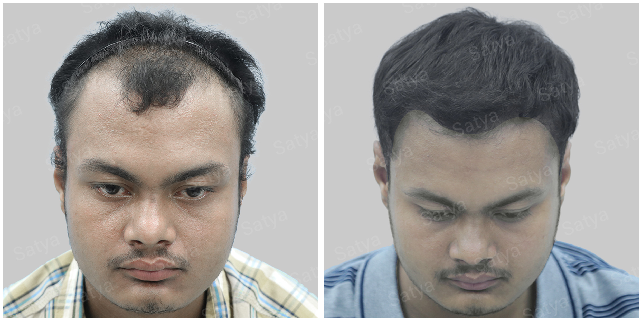 Best Hair transplant in India | Satya Hair Solutions